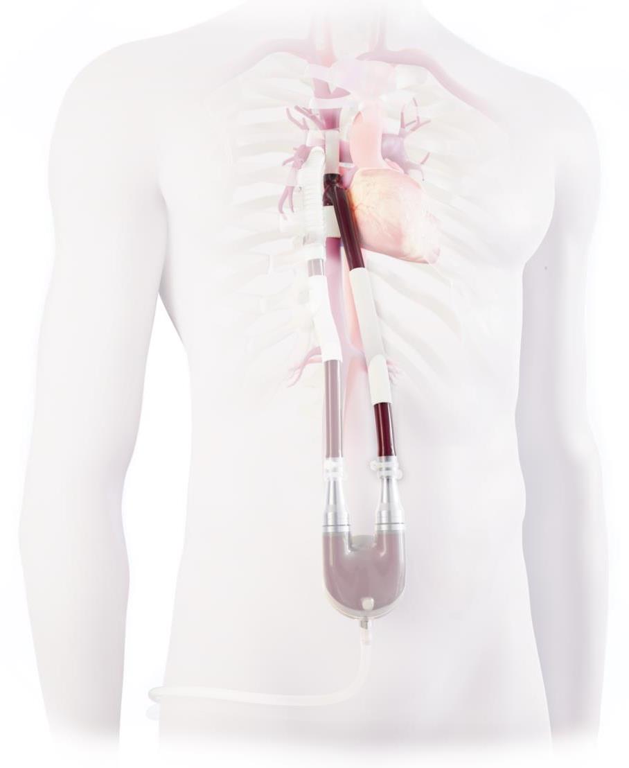 EXCOR - Venous Cannula - Medical Professionals - Subpulmonary ...