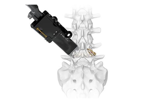 Karma / Karma MIS Novel Metal-Free Cortico-Pedicular Fixation System
