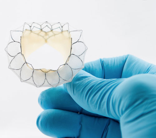 Neovasc Reducer - Treatment of Refractory Angina and Tiara ...