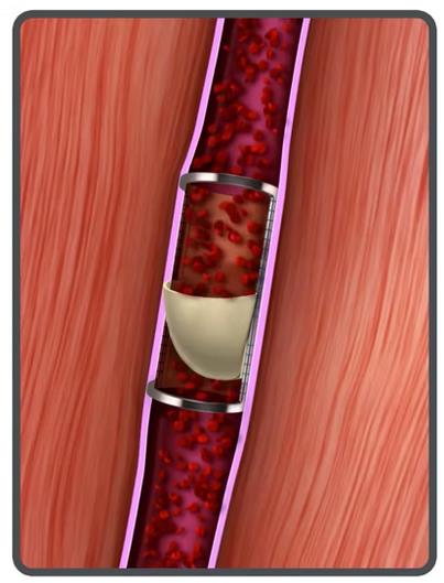 Venovalve Surgically Implanted Valve