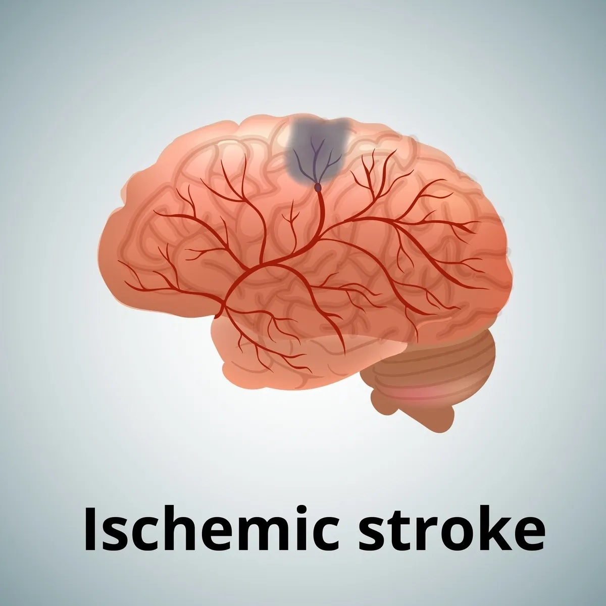 EPIC - Ischemic Brain Stroke Stimulation by EPIC Neuro, Inc.