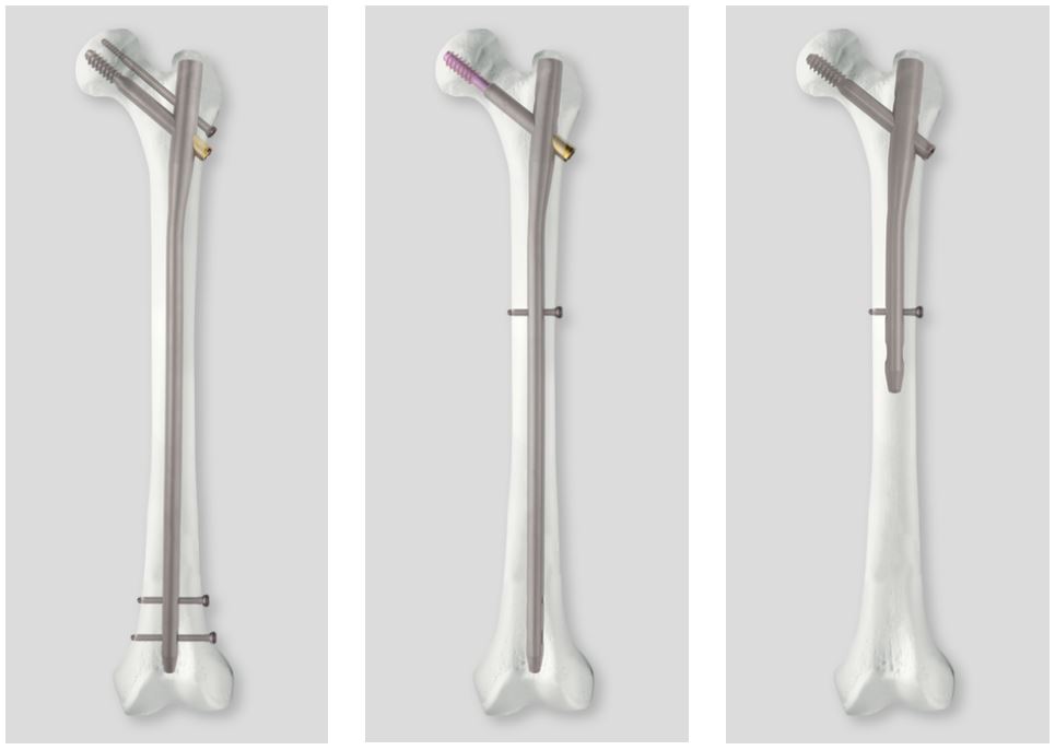 AOS Galileo Trochanteric Nail System