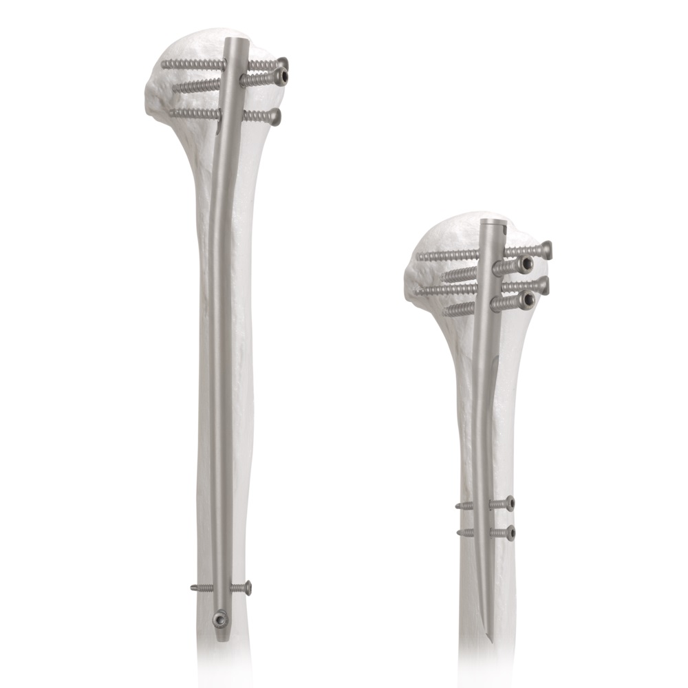 AOS Newton - Humeral Nail System by Advanced Orthopaedic ...