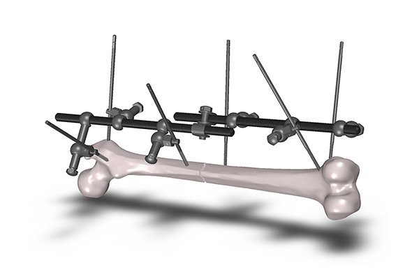 MedSpark - Large Bone External Fixation System by MedSpark, LLC