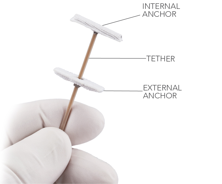 Revivent TC - Epicardial Anchor System Implant by BioVentrix,