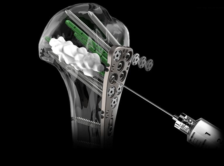 Biedermann - MDS - Extremity Solutions - Injection Screw by ...