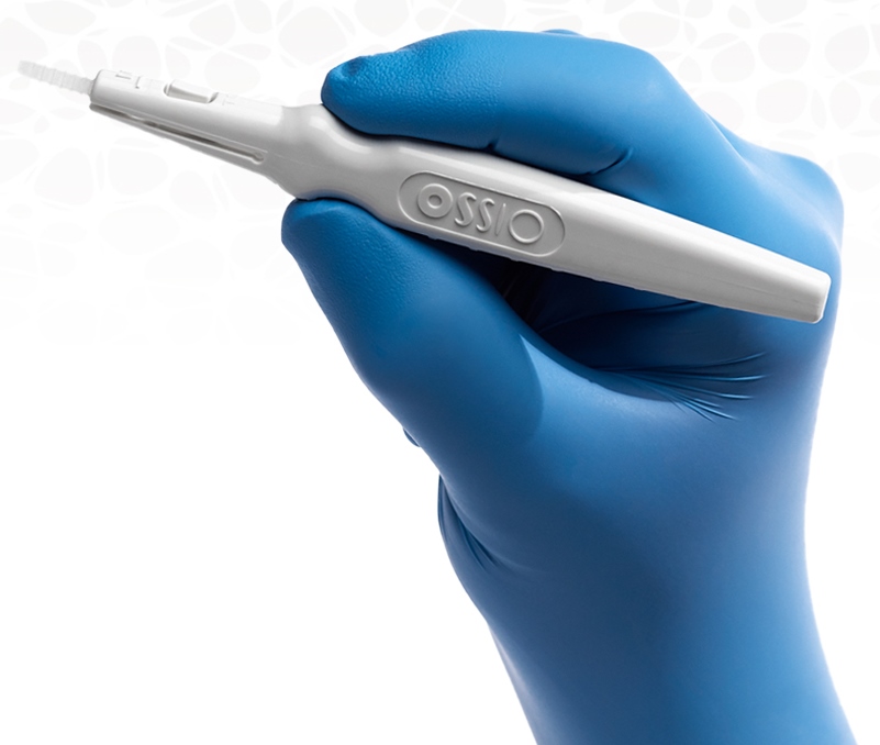 OSSIOfiber - Hammertoe Fixation System by OSSIO Inc