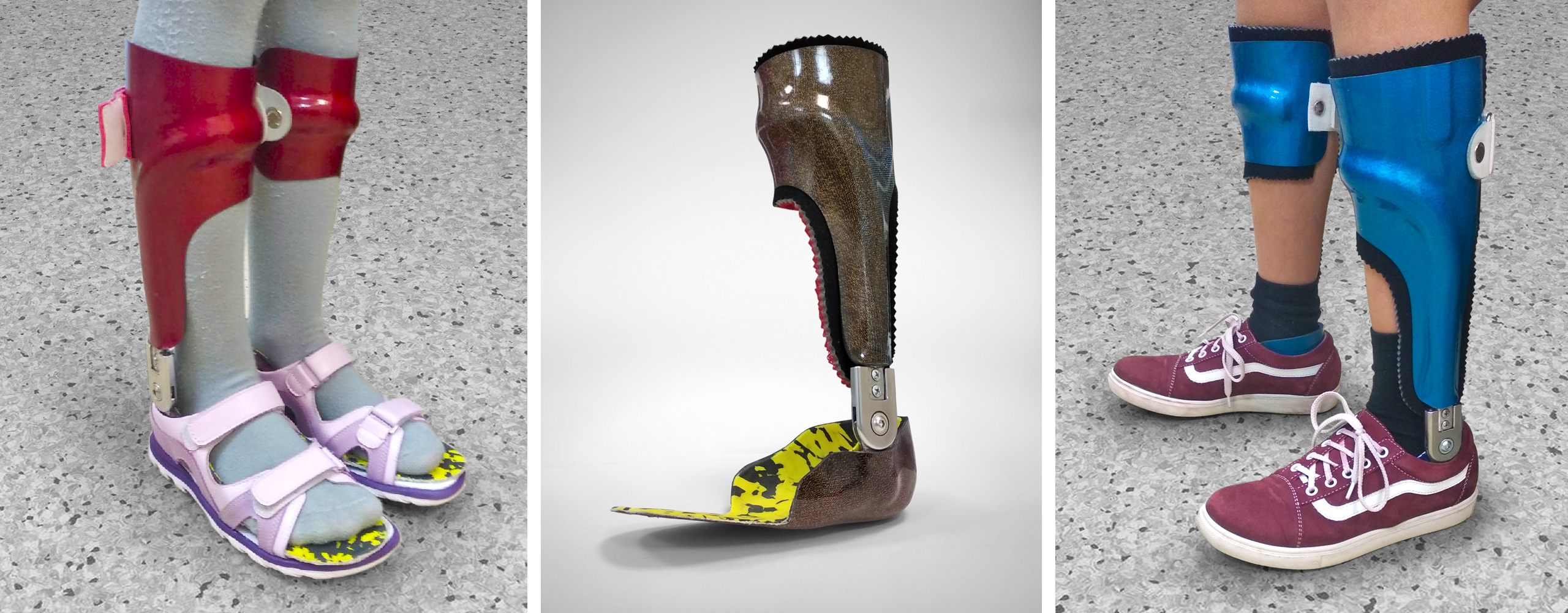 Upper and Lower Limbs Orthotics Service by Scoliologic.ru, LLC
