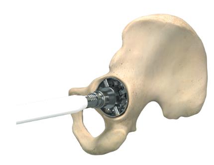 EasyHip - E-609 - Hip Replacement - Cemented Cups by GO ...