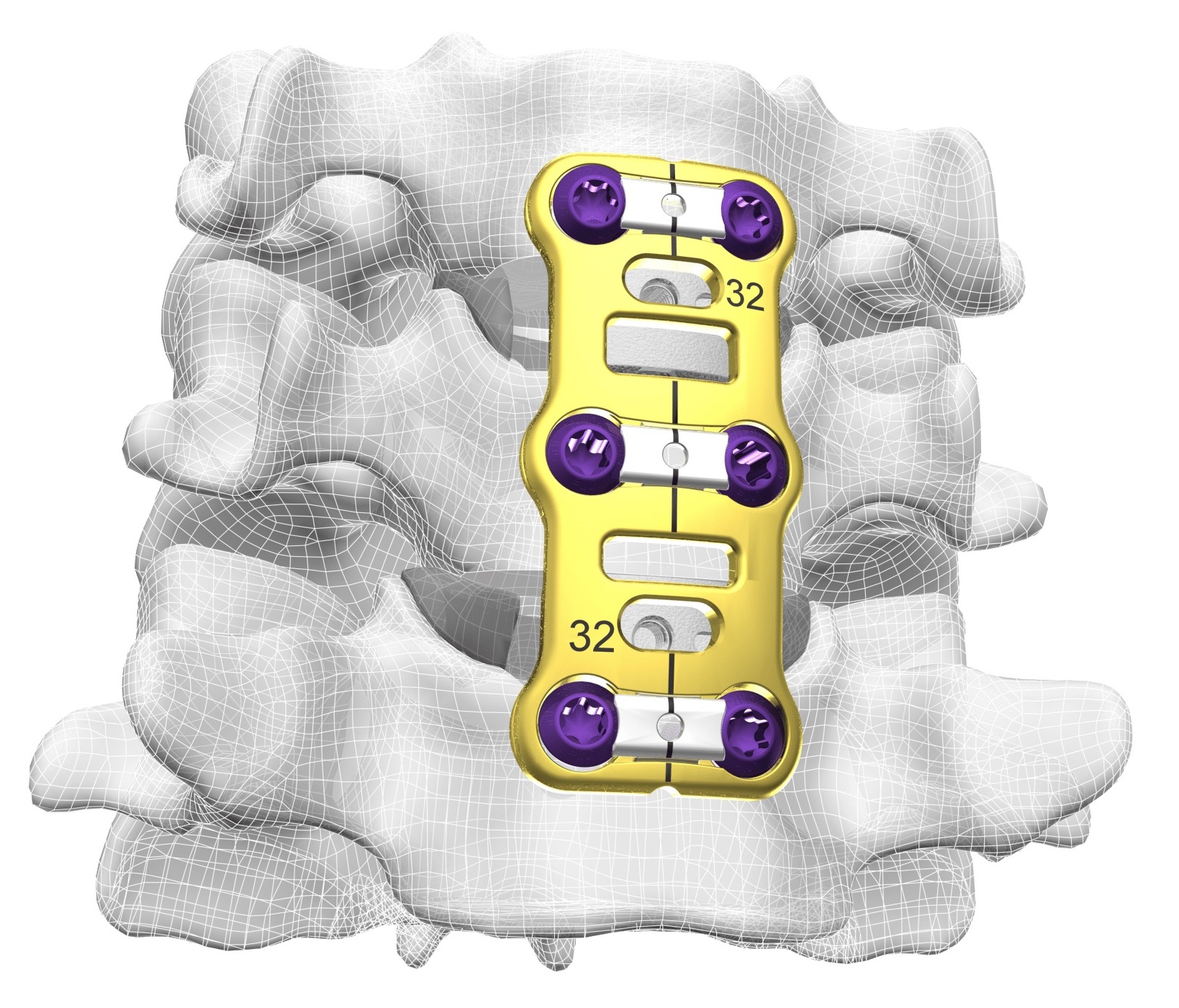 Terrace - Cervical - Anterior Cervical Plate System by ...