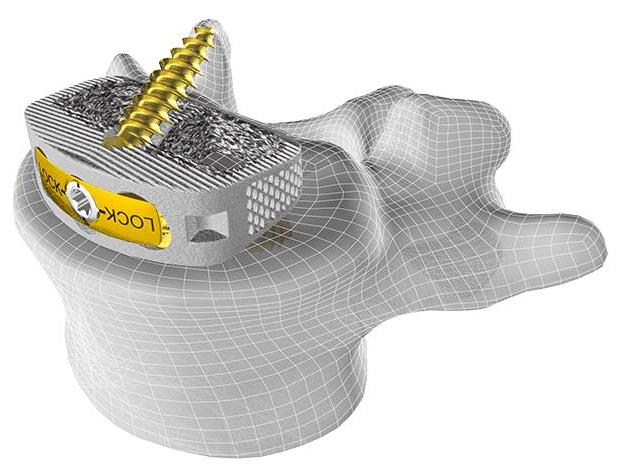 CoreLink - M3 - Anterior Lumbar - Stand-Alone ALIF System by ...