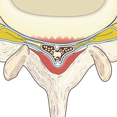 mild - Back and Leg Pain Solution by Vertos Medical, Inc.