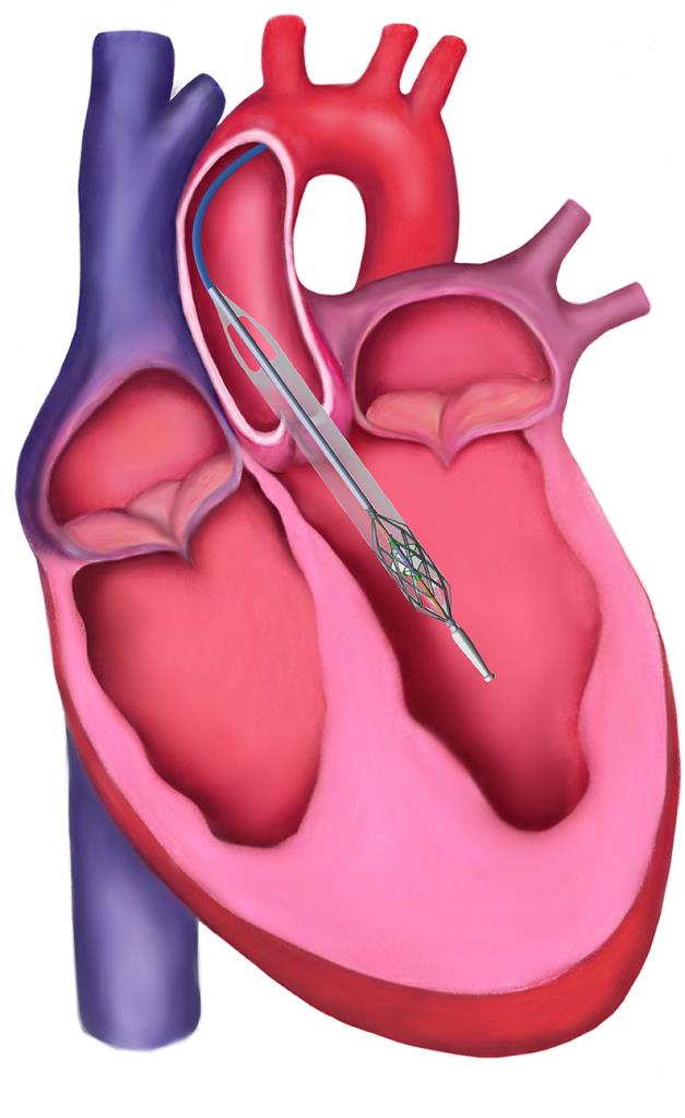 Magenta Plvad Self-Expanding Percutaneous Left Ventricular Assist Device