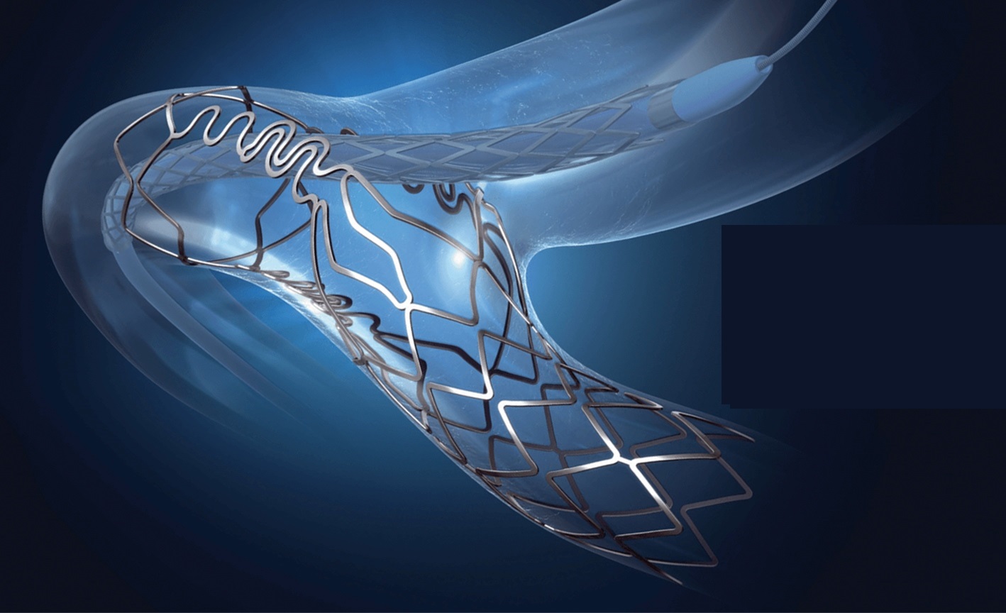 Tryton - Side Branch Stent by Tryton Medical, Inc.