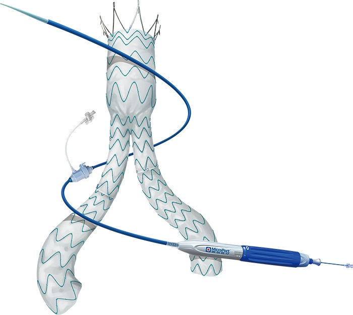 Minos - EVAR Device By Lombard Medical Limited