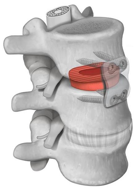 Parametrics - Demineralized Bone Matrix (DBM)
