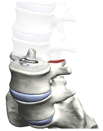 Tyber - Transforaminal Lumbar Interbody Fusion (TLIF) by ...