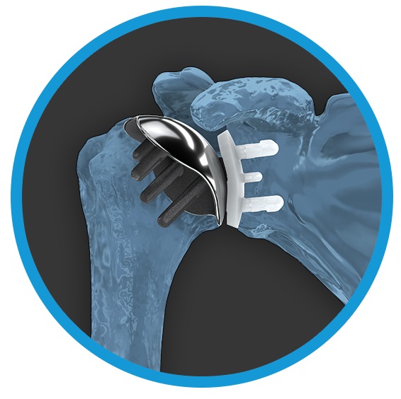 Archer - CSR - Total Shoulder System By Catalyst Orthoscience Inc.