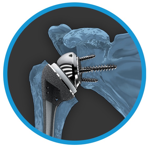 Archer R1 Reverse Shoulder System