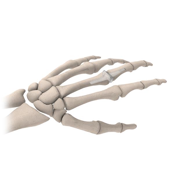 Osteotec Silicone Finger Implant