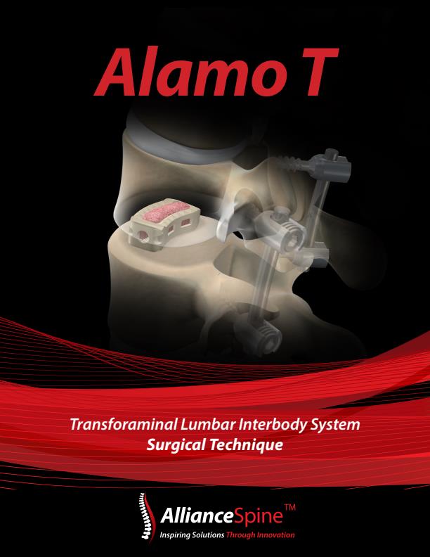 Alamo - Model T - Transforaminal Lumbar Intervertebral Device - Brochure