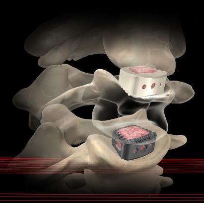 Alamo C Anterior Cervical Intervertebral Device