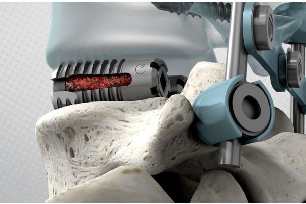 VariLift-LX - Technologies - Stand-Alone Expandable Lumbar ...