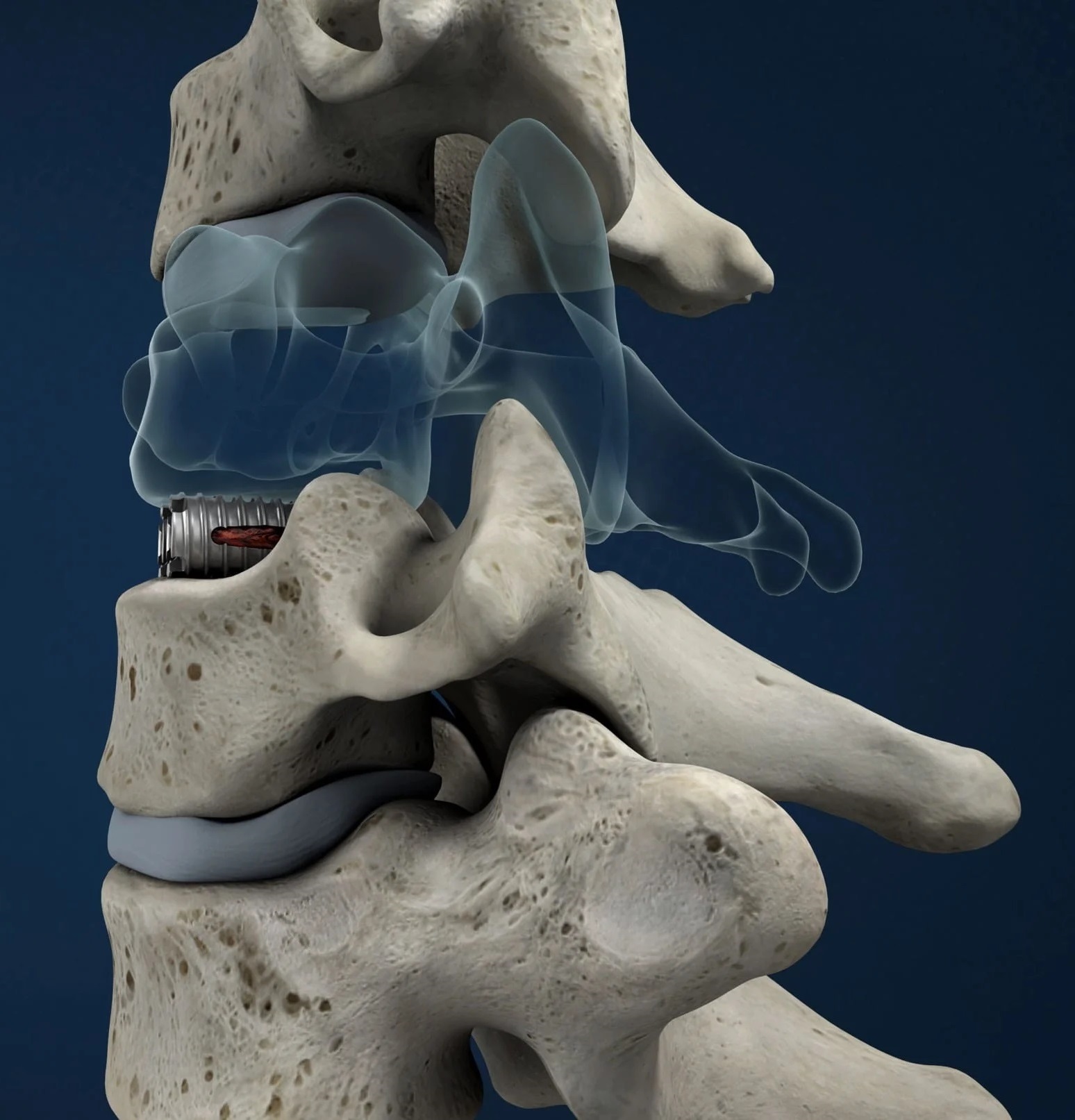 VariLift-C - Technologies - Stand-Alone Expandable Cervical ...