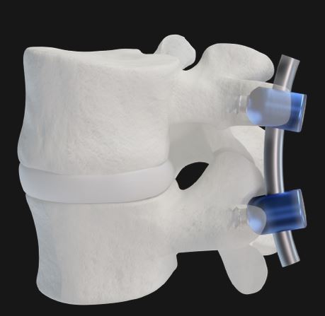 PressON - PressON - Single Level Spinal Implant by Nexus Spine