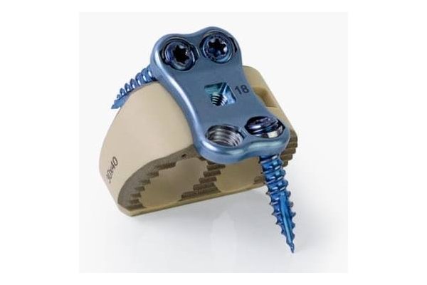 Idys ALIF Stand-Alone Anterior Lumbar Cage + Plate System