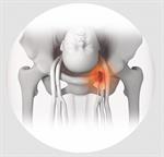 Neuromuscular Electrostimulation Device for VTE Prevention – Obstetrics ...