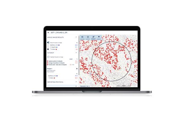 Aiforia ER Clinical AI Model For Breast Cancer
