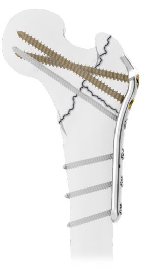 Intrauma PFF Modular Hook For Treating Proximal Femur Fractures