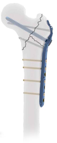 Intrauma - PFF Titanium - Lower Limb - Femur - Proximal Femur ...