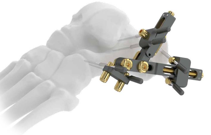 Intrauma - TAKO Fix - Lower Limb - Calcaneus - Calcaneal External ...