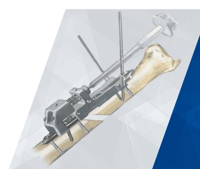 Avanti - Ulnar Shortening System by Avanti Orthopaedics, LLC