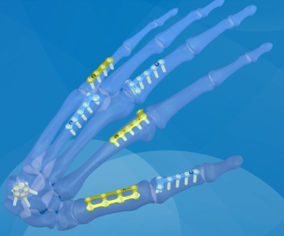 Flower - Upper Extremities - Hand by Flower Orthopedics
