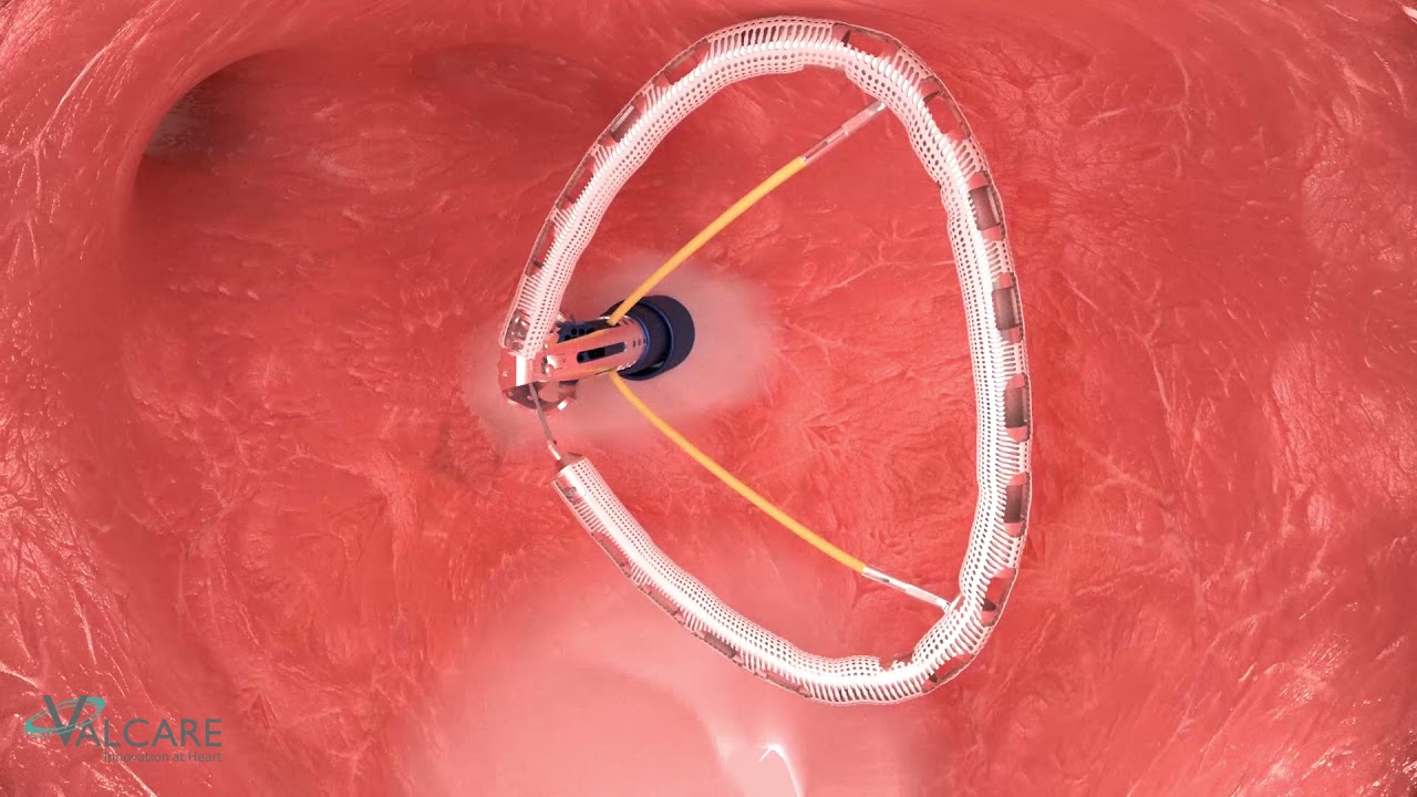 Helios Valcare - Novel Mitral Valve Replacement by Valcare ...