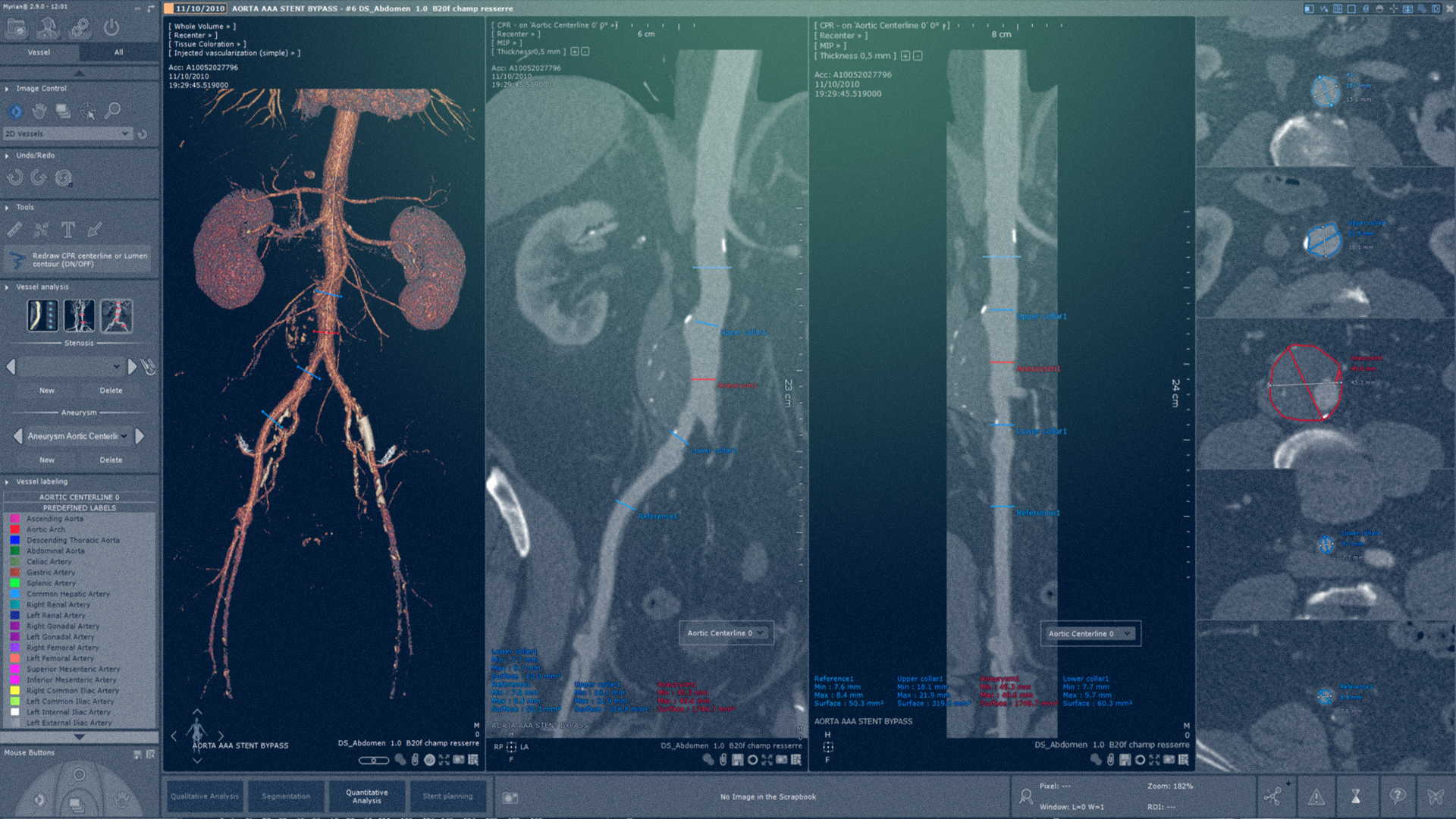 Myrian - XP-Vessel And XP-Cardiac - Multi-Modality Visualization Of ...