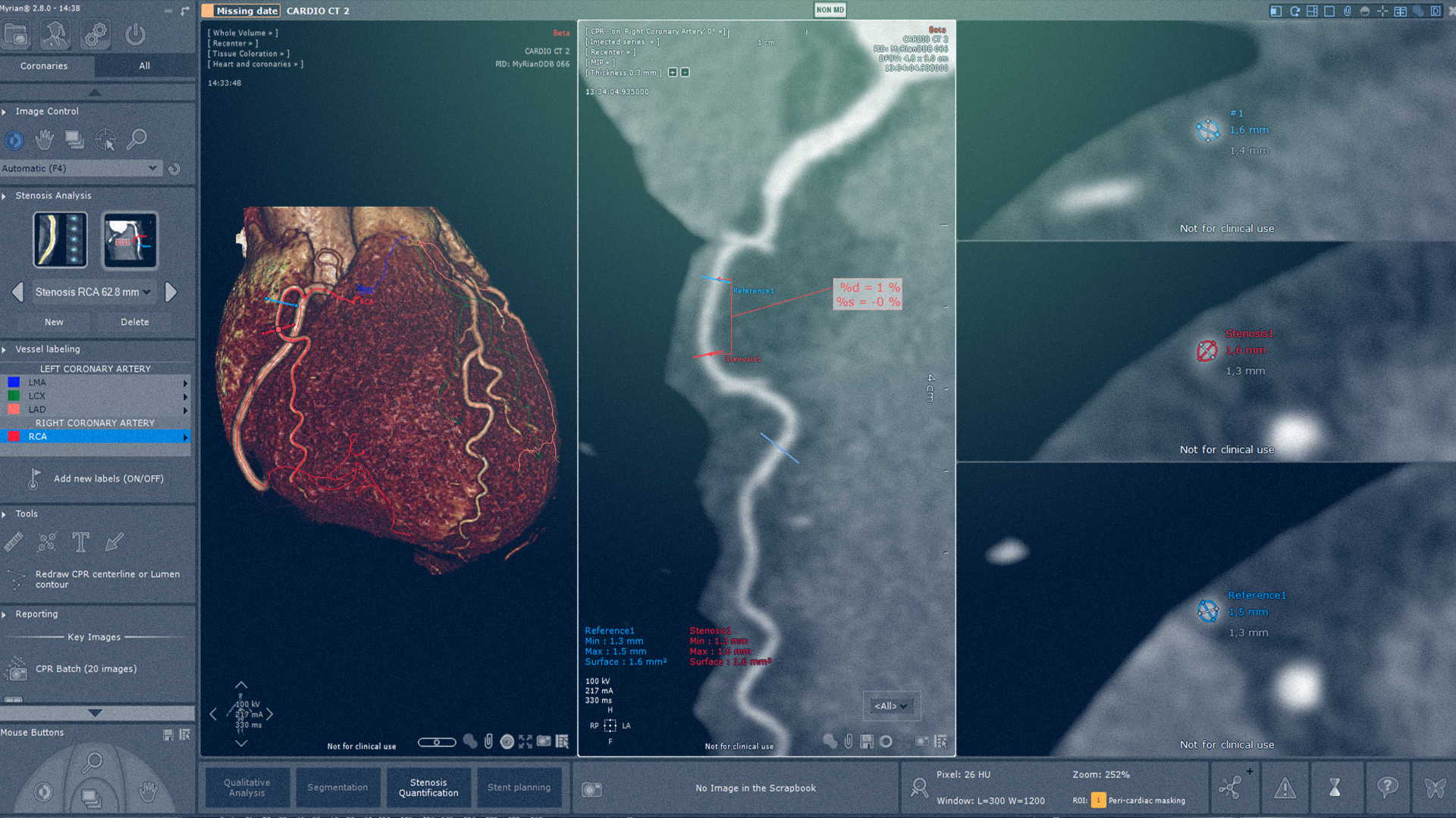 Myrian - XP-Vessel And XP-Cardiac - Multi-Modality Visualization Of ...
