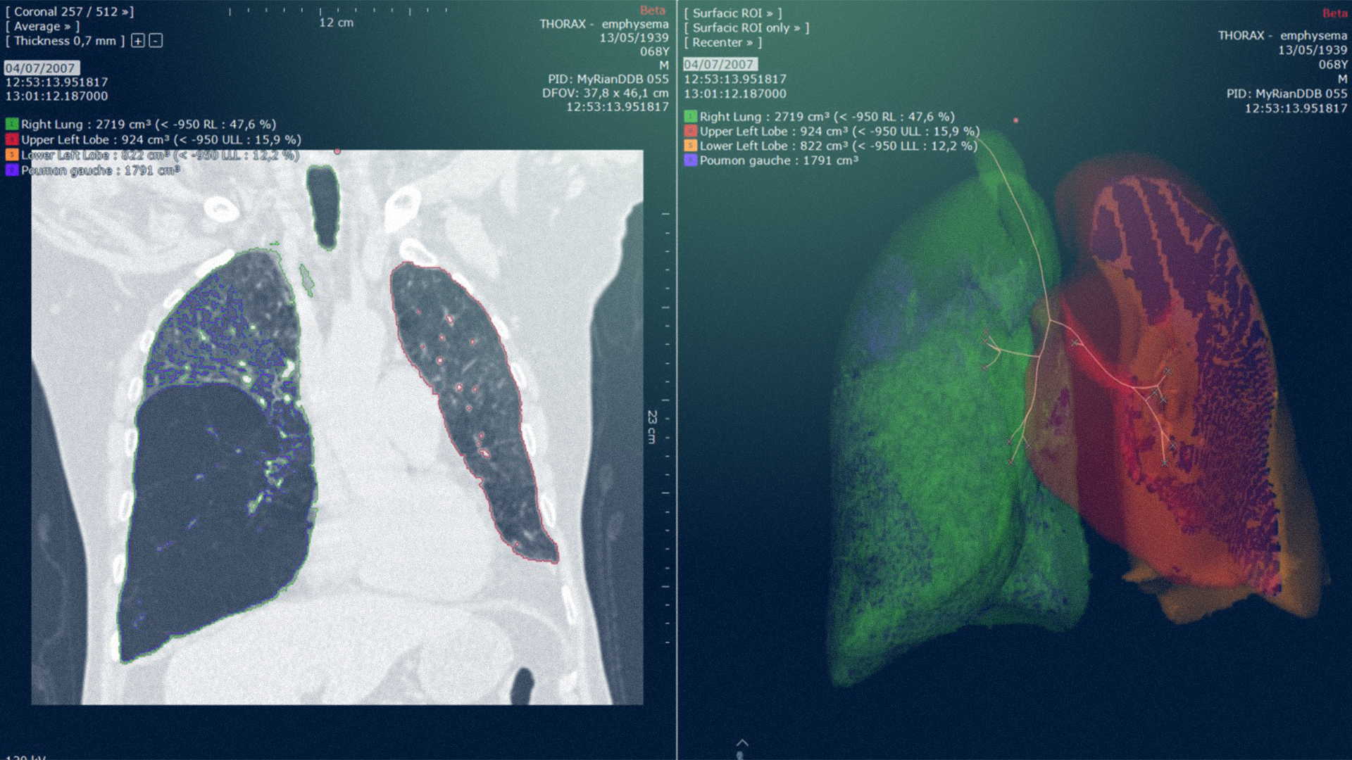 Myrian - XP-Lung And XP-Lung Nodule - Automatic Segmentation And ... Myrian - XP-Lung And XP-Lung Nodule - Automatic Segmentation And ...