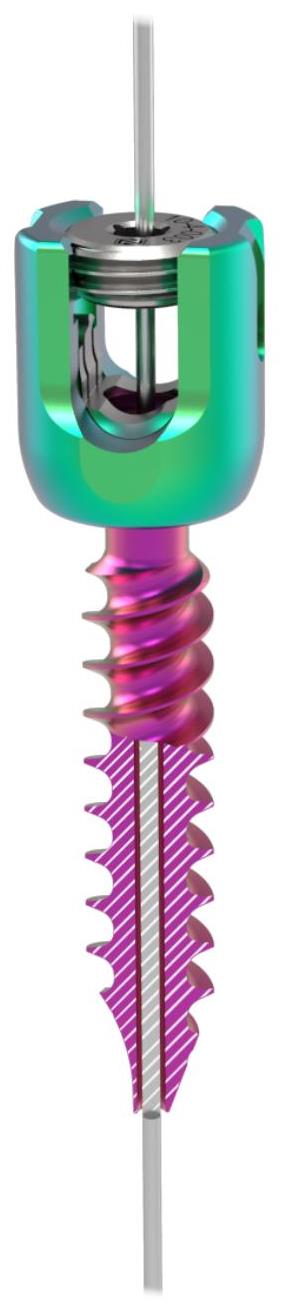 Inertia MIS Pedicle Screw System