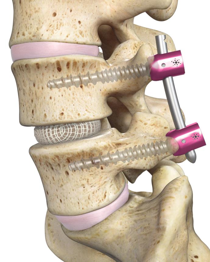 Optimesh Expandable Interbody Fusion System
