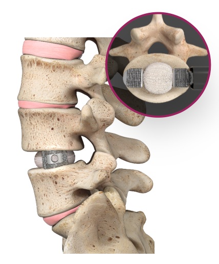 Duo - Ti - Interbody - Expandable Interbody Fusion System by ...