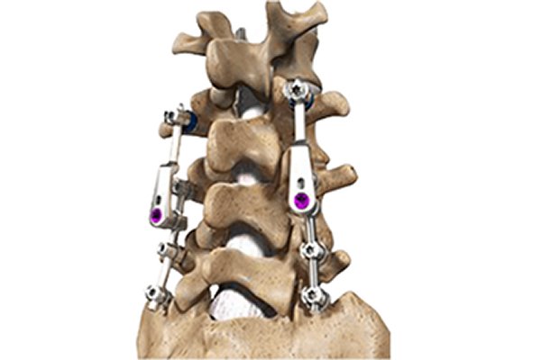 Spinewave Annex Adjacent Level System