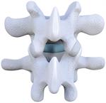 Zenfuze Lumbar Fusion System