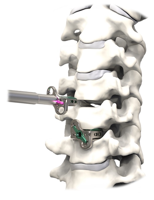 Atlas - HiJAK SA - Technologies - Cervical - Cervical Stand ...