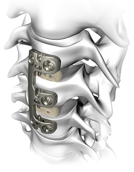 Atlas - Verteview - Technologies - Cervical - Cervical ...