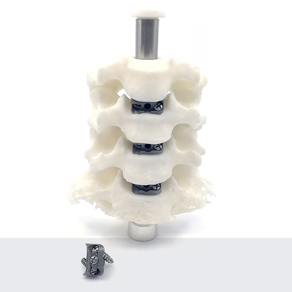 3D Medical - Human - Custom Made Spinal Cage by 3D Medical