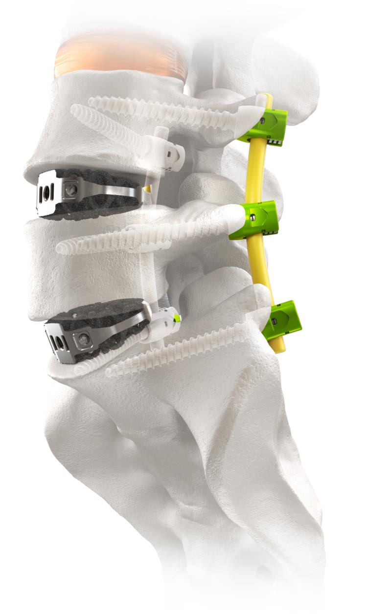 Spira - ALIF - Lumbar - Titanium Open Matrix Architecture Implant By ...